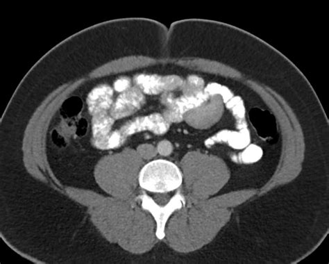Small Bowel Gist Tumor Missed On Axial Report Small Bowel Radiology
