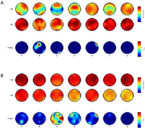 Figure 5 From Microstate Based Brain Network Dynamics Distinguishing Temporal Lobe Epilepsy