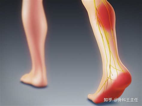 坐骨神经痛和椎间盘突出？不要再分不清了，该不该动手术 知乎