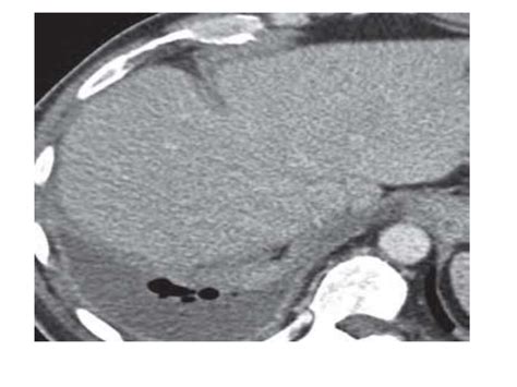 Hepatobiliary Imaging Anatomy Radiology Pptx