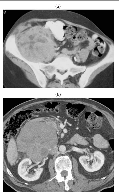 Table 1 From Retroperitoneal Sarcomas Semantic Scholar
