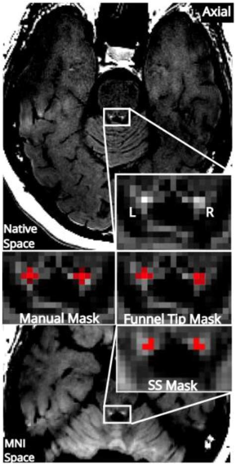 Three Different Locus Coeruleus Lc Segmentation Approaches Download Scientific Diagram