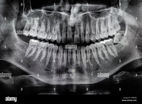 Orthopantomography Opg X Ray Dr Digital Wisdom Teeth Panoramic Film X