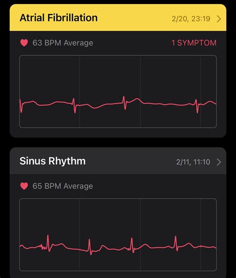Ecg Ekg Atrial Fibrillation Afib Atrial Flutter Off