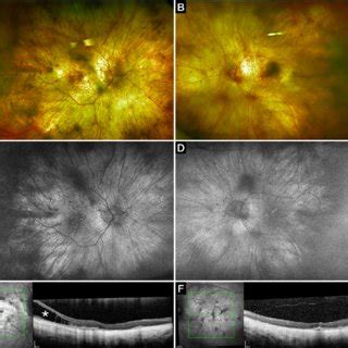 Multimodal Imaging Of Case 2 A B Optos Fundus Photographs Reveal