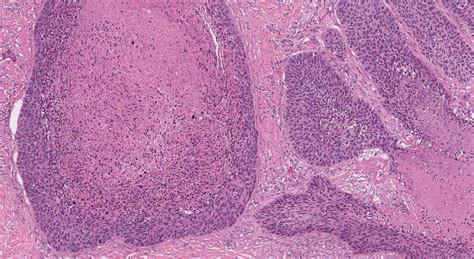 Hpv Associated Squamous Cell Carcinoma In The Oral Cavity Atlas Of