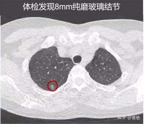 肺结节患者有以下4种情况，就可以“偷着乐” 知乎