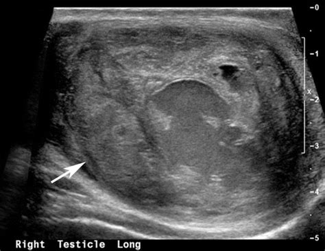 Embryonal Cell Carcinoma Ultrasound