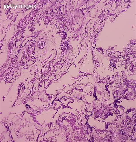 Lipoma On Loin Benign Growth Of Fatty Tissue Benign Neoplasm