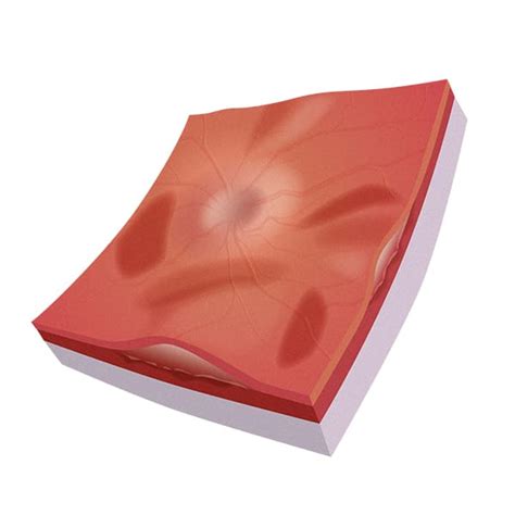 What Is Retinal Oedema