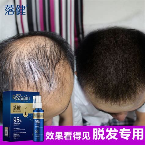 落健Rogaine生发液男女脂溢性止脱增长发际线增发产后脱发育发液 东华美发生物科技