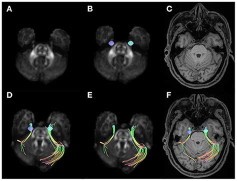 Trigeminal Nerve Mri Protocol