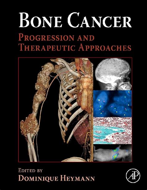 Bone Cancer Pictures