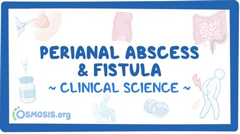 Perianal Fistula Etiology Clinical Features Goodsall 52 Off
