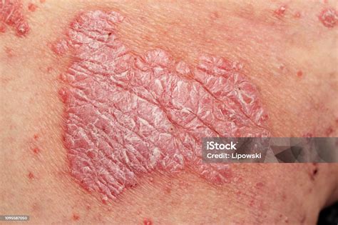 세부의 간 경 변 피부 질환 건 선 Vulgaris 좁은 초점 피부 패치는 일반적으로 가려움 붉은 비늘 건선에 대한 스톡 사진