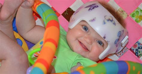 Cranial Orthoses And Orthotics In St Louis Orthotic And Prosthetic Lab Inc
