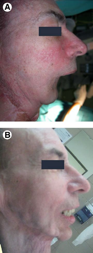 Implant Supported Prosthesis In A Patient With Fibular Free Flap