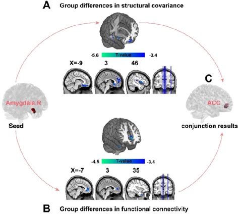 Figure 1 From Amygdala Based Structural Covariance And Functional Connectivity Alterations In