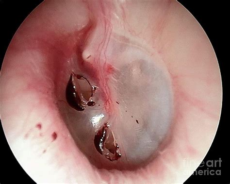 Ruptured Eardrum Bleeding