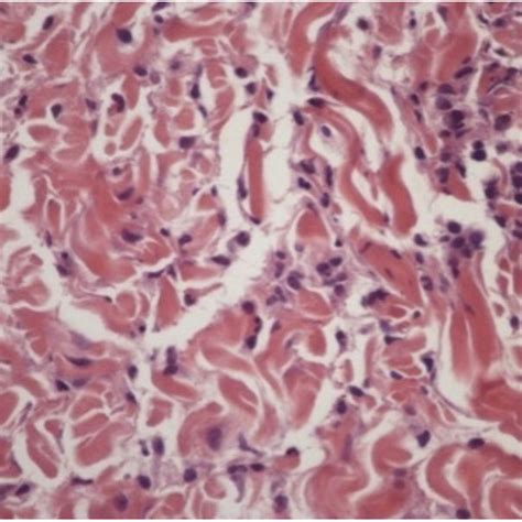 Erythematous Annular Plaques With Lighter Centers In The Abdomen