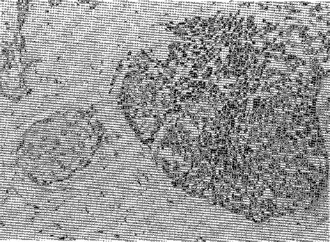 Thymic Squamous Cell Carcinoma Semantic Scholar