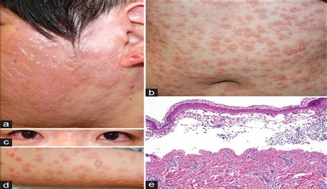 Eruptive Melanocytic Nevi After Toxic Epidermal Necrolysis