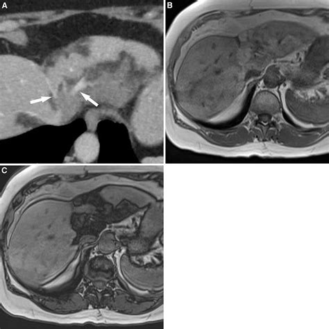 Multiple Large Confluent Mass Like Fat Deposition In A 69 Year Old