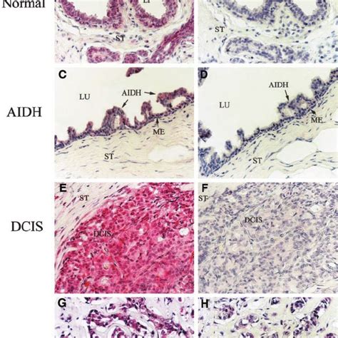 Expression Of Matrix Metalloproteinase Mmp 9 And Tissue Inhibitor Of