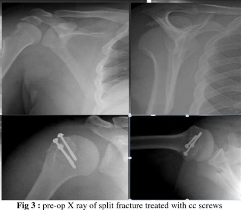 Greater Tubercle Of Humerus Fracture