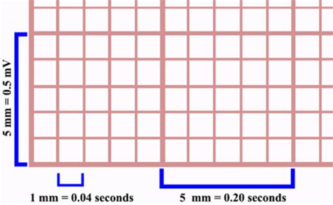 Chapter 2 Ekg Recording Flashcards Quizlet