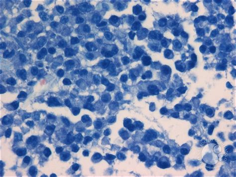 Extramedullary Plasmacytomas 2
