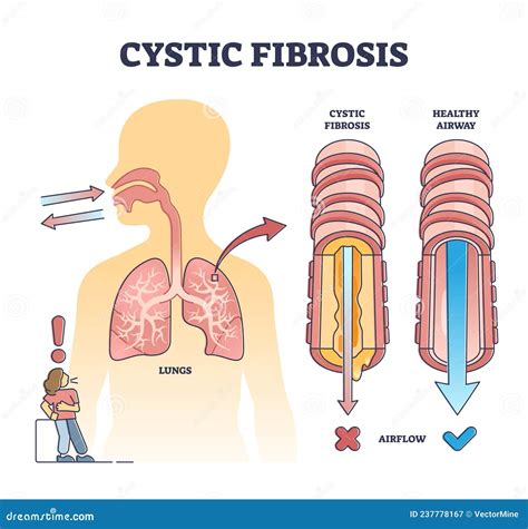 Cystic Fibrosis Awareness Month Background Or Banner Design Template