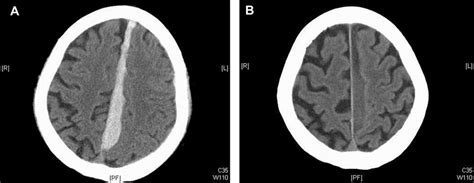 A Computed Tomography Ct Of The Brain Showing A Left Download