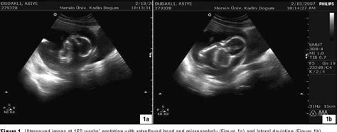 Iniencephaly Ultrasound