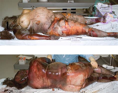 Decomposition Of The Entire Body R NSFL