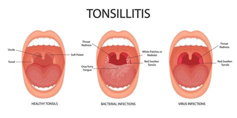 Angina Tonsillitis Over 269 Royalty Free Licensable Stock Vectors