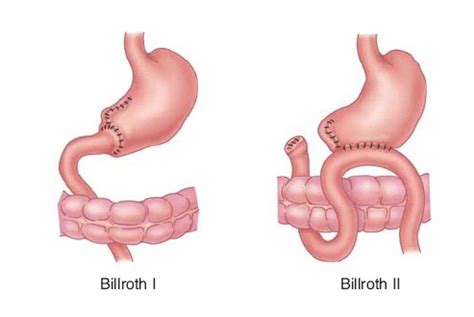 Billroth Ii