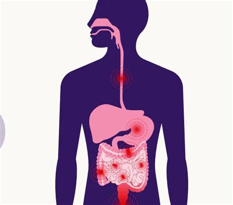 Doença de Crohn tem cura O que é e tratamento Cuidados Pela Vida
