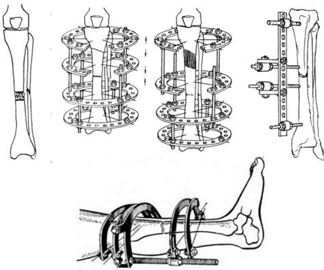 Лечение переломов Основы хирургии с травматологией