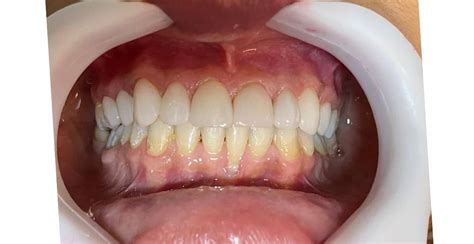 Como São Aplicadas As Lentes De Contato Dental Ortocenter