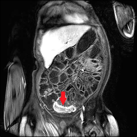 Ileal Wall Thickening Red Arrow And Hyperenhancement On Magnetic
