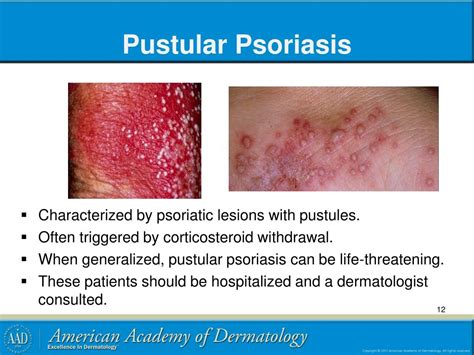 Ppt Psoriasis Powerpoint Presentation Free Download Id2817104