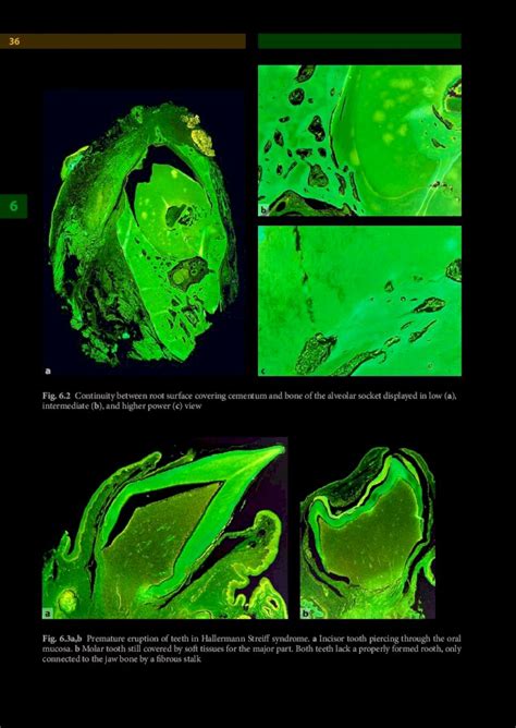 Pdf Disturbed Tooth Eruption · 82 Gingival Hyperplasia Gingival