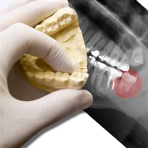 Cuál es el precio de la extracción de una muela del juicio Clínica Dental AVODENT