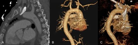 A Computed Tomography Angiography Cta Demonstrating A Mobile Mural Download Scientific