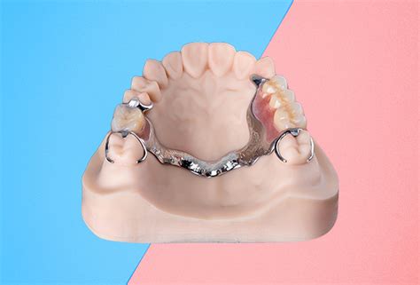 Vitallium Dentures Precision Partial Frameworks By Istar
