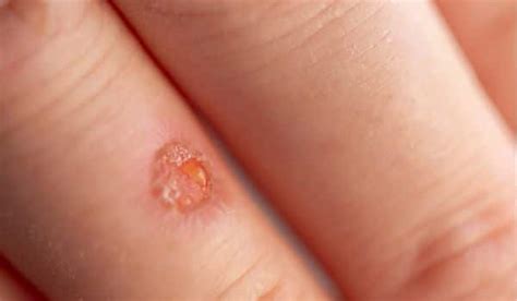 Skin Nodule Treatment