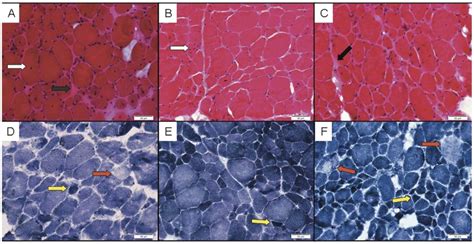 Histological Analysis Of Patients Muscle Biopsies Frozen Sections Of 3