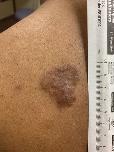 Skin Plaque