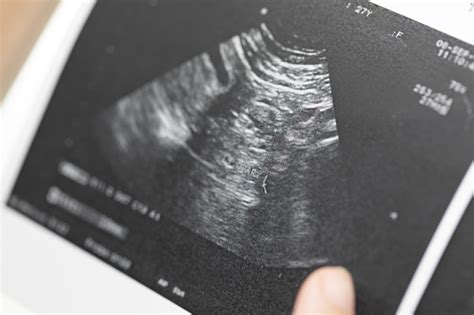 임신 초음파에 의해 임신한 여자의 테스트 결과 읽고 의사에에서 아기의 초음파 X 레이에 대한 스톡 사진 및 기타 이미지 X